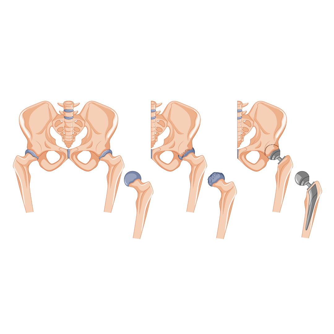 Hip And Knee Joint Replacement - Dr. R.S. Bajoria